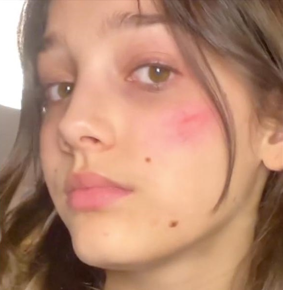 Arriva in Veneto la pericolosa challenge della cicatrice francese. La Polizia: "Vegliate sui ...